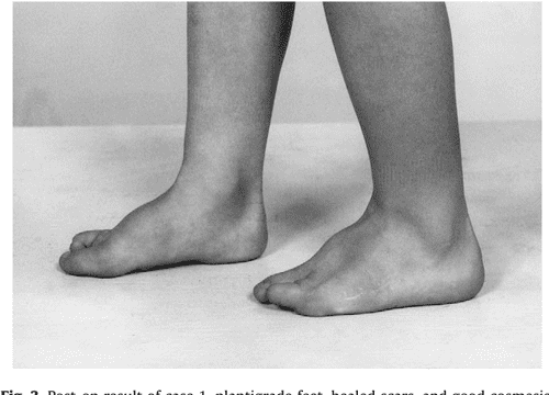 Figure 4 from Congenital cleft foot deformity. | Semantic Scholar