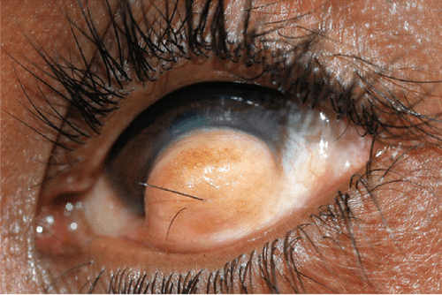 [PDF] Management of pediatric corneal limbal dermoids | Semantic Scholar