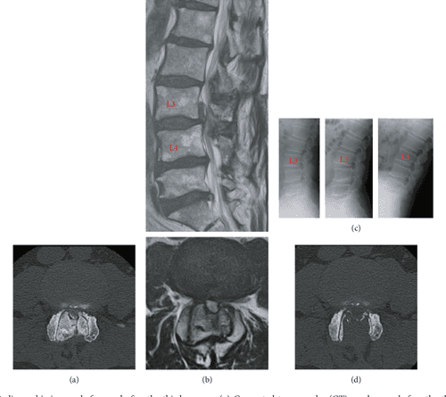 [PDF] Lumbar Canal Stenosis Caused by Marked Bone Overgrowth after ...