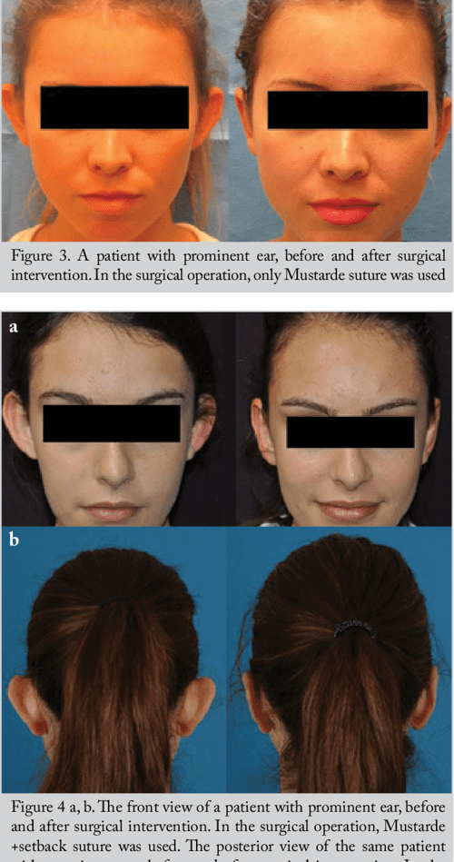 Figure 2 from Otoplasty Outcomes and Results: Does Furnas Setback ...