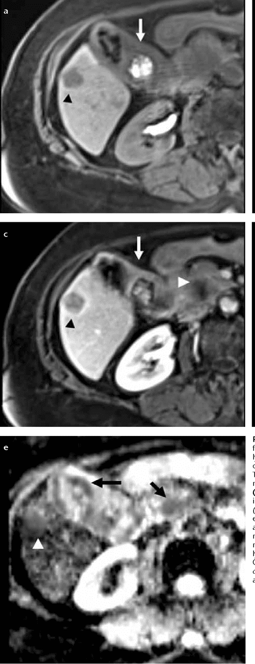 MRI of gallbladder cancer. | Semantic Scholar