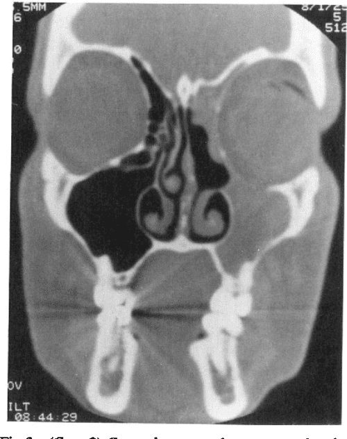 Figure 1 from Atelectasis of the Maxillary Sinus with Enophthalmos and ...