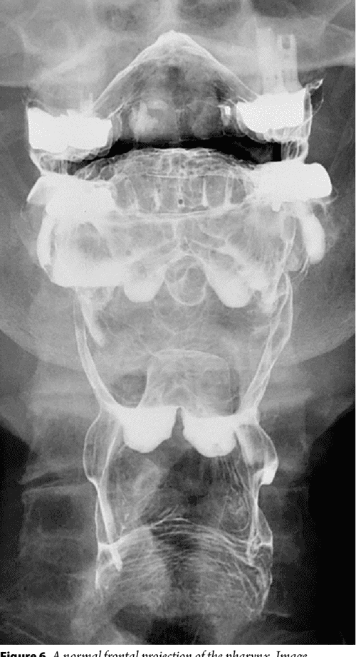 Modified Barium Swallow for Evaluation of Dysphagia. | Semantic Scholar