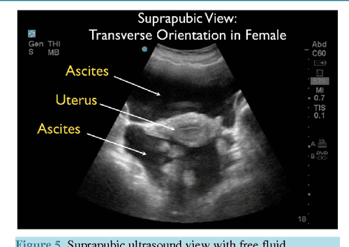 Figure 2 from Ultrasound for Detection of Ascites and for Guidance of ...