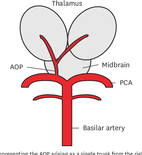 Figure 2 from Clinical Features of an Artery of Percheron Infarction: a ...