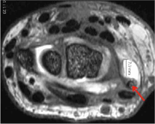 Prestyloid recess of the wrist: normal appearance on 3T MR arthrography ...