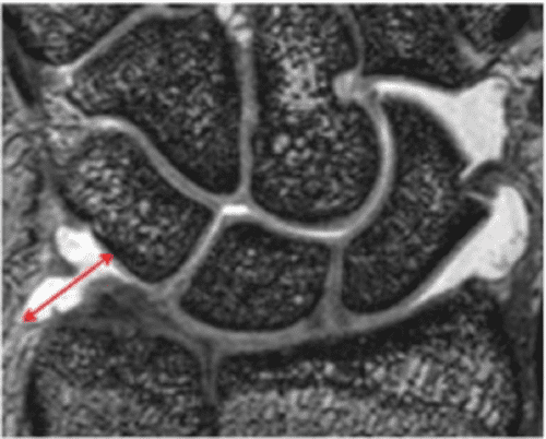 Prestyloid recess of the wrist: normal appearance on 3T MR arthrography ...