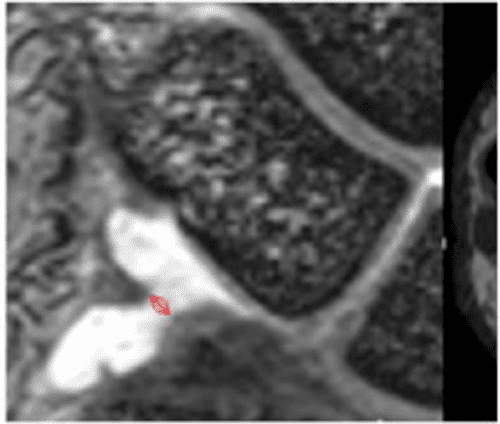 Prestyloid recess of the wrist: normal appearance on 3T MR arthrography ...