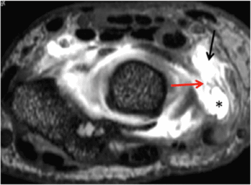 Prestyloid recess of the wrist: normal appearance on 3T MR arthrography ...