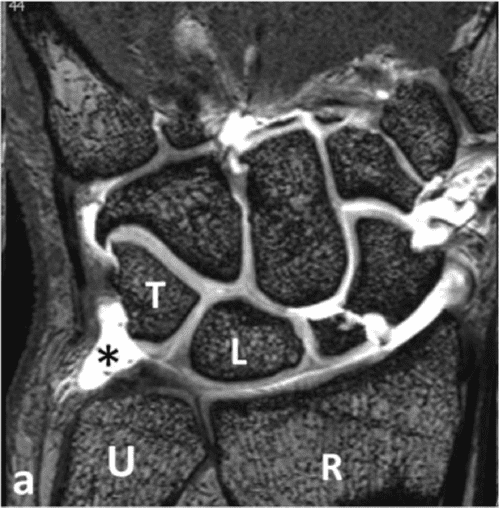 Prestyloid recess of the wrist: normal appearance on 3T MR arthrography ...
