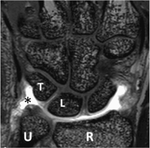 Prestyloid recess of the wrist: normal appearance on 3T MR arthrography ...