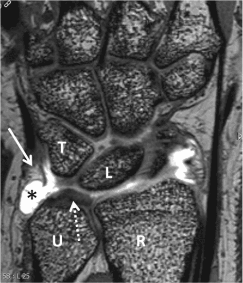 Prestyloid recess of the wrist: normal appearance on 3T MR arthrography ...