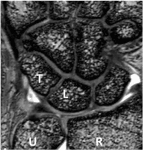 Prestyloid recess of the wrist: normal appearance on 3T MR arthrography ...