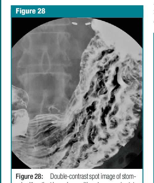 [PDF] Double-contrast upper gastrointestinal radiography: a pattern ...