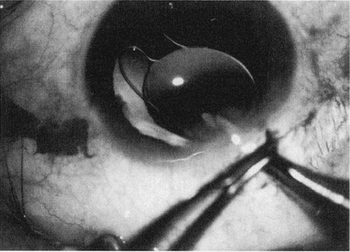 Centration of intraocular lenses with circular haptics | Semantic Scholar
