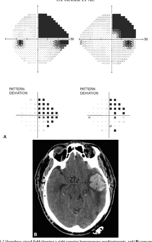 Disorders of the optic tract, radiation, and occipital lobe. | Semantic ...