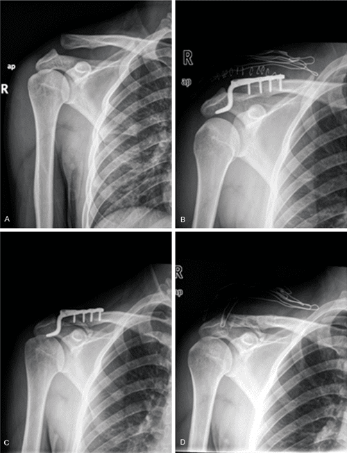 [PDF] Effects of hook plate on shoulder function after treatment of ...