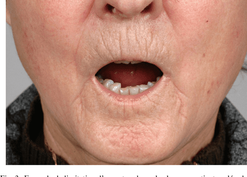 Figure 2 from [Orofacial manifestations of systemic sclerosis: a study ...