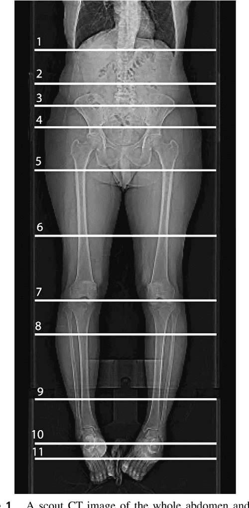 Optimization of the table speed of lower extremity CT angiography protocols in different patient ...