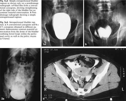 Bladder rupture from external trauma: diagnosis and management ...