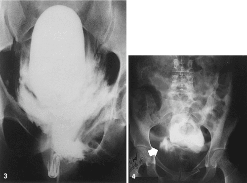 Bladder rupture from external trauma: diagnosis and management ...