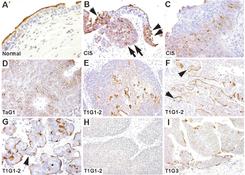 Figure 1 from Persistent uroplakin expression in advanced urothelial ...