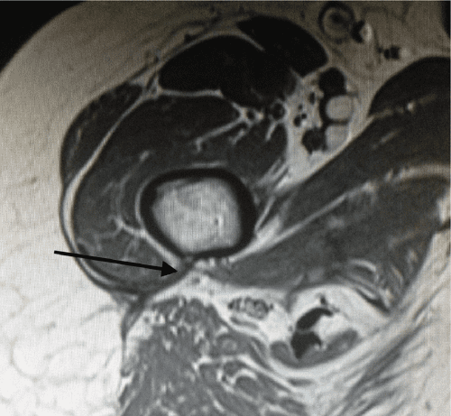 Figure 7 from MRI findings in gluteus maximus tendinopathy - the ...