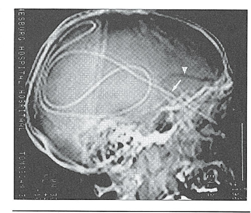Intracranial Placement of a Nasogastric Tube after Complex Craniofacial ...