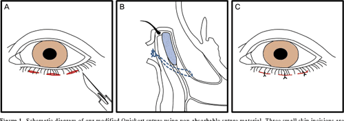 Figure 1 from Quickert Suture Using Nonabsorbable Suture Material for ...