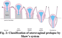 Association between the standardized pelvic organ prolapse quantification system (POP Q) and ...