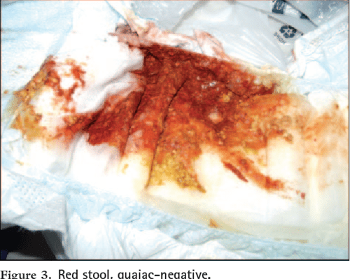 Figure 1 from Gastrointestinal bleeding in infants and children ...