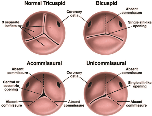 [PDF] Unicuspid Aortic Valve | Semantic Scholar