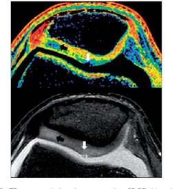 A new MRI grading system for chondromalacia patellae | Semantic Scholar