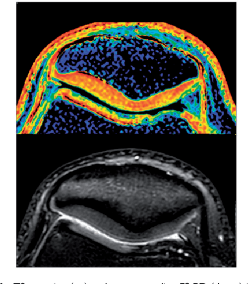 A new MRI grading system for chondromalacia patellae | Semantic Scholar