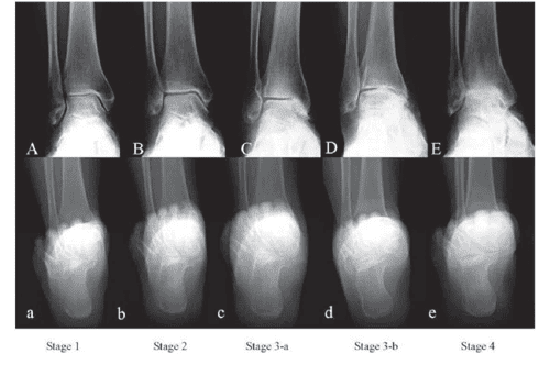 Table 1 from The Use of Osteotomies in the Treatment of Asymmetric ...