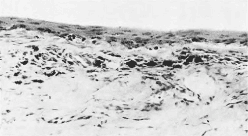 Figure 2 From Corneal Pannus chronic Superficial Keratitis In The figure-2-from-corneal-pannus-chronic-superficial-keratitis-in-the