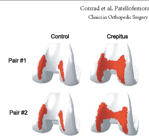 Figure 10 from Patellofemoral Crepitus after Total Knee Arthroplasty ...