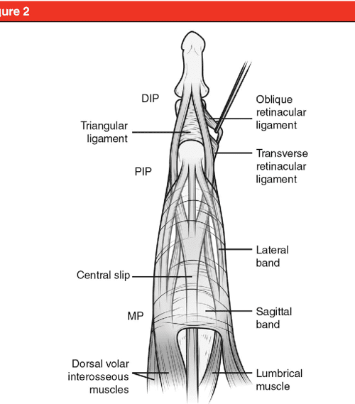 Figure 2 from Closed Sagittal Band Injury of the Metacarpophalangeal ...