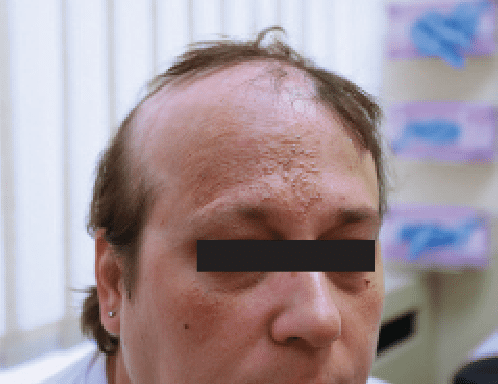 Favre-Racouchot Syndrome in a 39-Year Old Female following Radiation ...