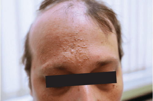 Favre-Racouchot Syndrome in a 39-Year Old Female following Radiation ...