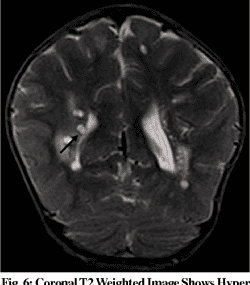 Figure 1 from Lowe Syndrome ( Oculo-cerebro-renal Syndrome of Lowe ...