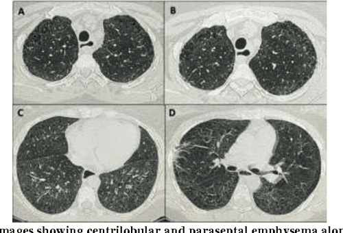 [PDF] Combined Pulmonary Fibrosis and Emphysema ( CPFE ) : A distinct ...