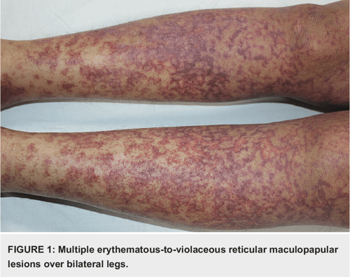 Figure 1 from Reticular Skin Rash as an Adverse Effect of 5-Azacitidine ...