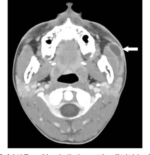 Figure 4 from Congenital dilatation of Stensen's duct in siblings ...