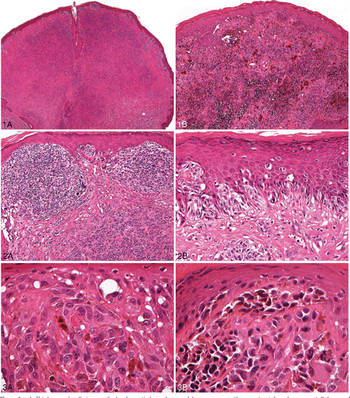 Figure 1 from Atypical genital nevus. | Semantic Scholar
