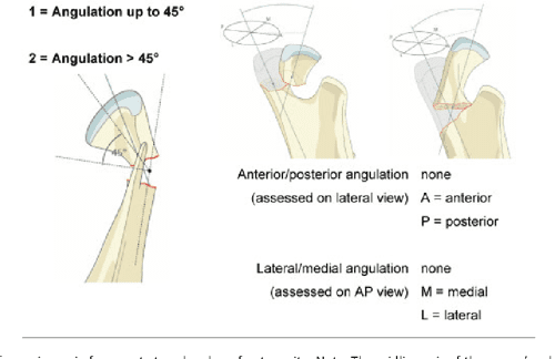 [PDF] The Comprehensive AOCMF Classification System: Condylar Process ...
