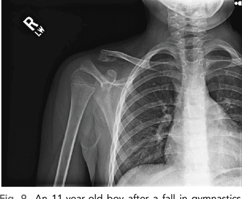 Figure 2 from Shoulder Injuries in Pediatric Athletes. | Semantic Scholar