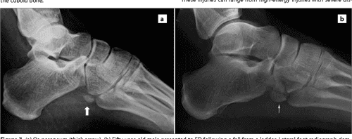 Figure 1 from The Accessory Ossicles of the Foot and Ankle; a ...