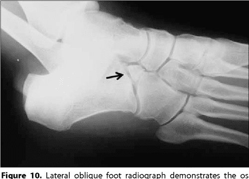 Figure 1 from The Accessory Ossicles of the Foot and Ankle; a ...
