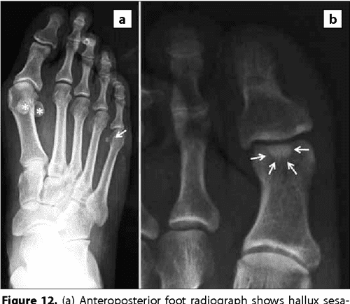 Figure 1 from The Accessory Ossicles of the Foot and Ankle; a ...